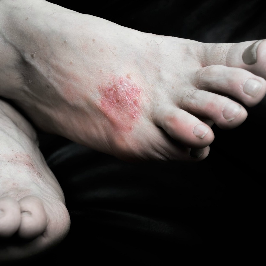 Treating a Rash on Feet | ThriftyFun