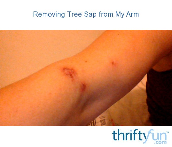 Removing Tree Sap from My Arm? | ThriftyFun