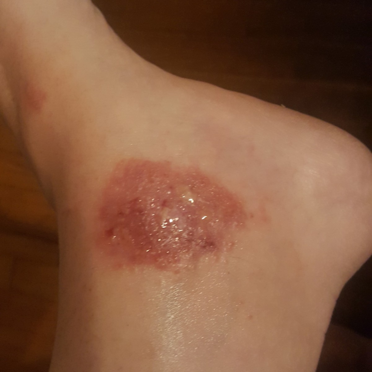 Treating a Rash on My Ankle? | ThriftyFun