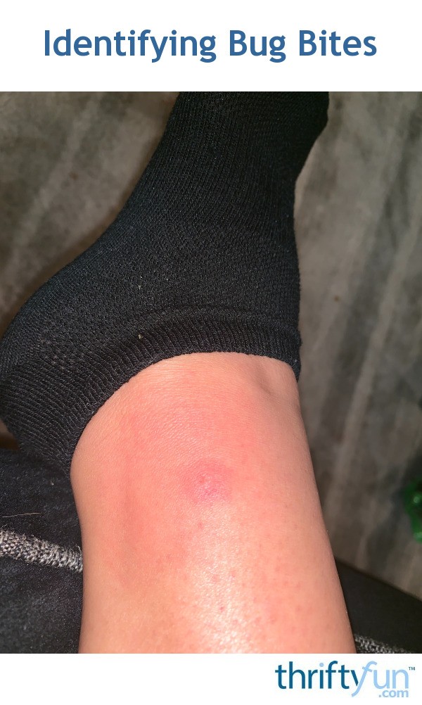 Identifying Bug Bites Thriftyfun